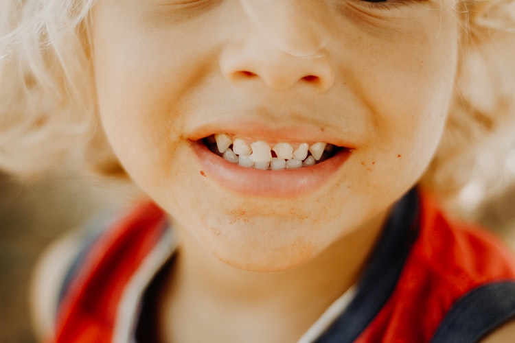 Tooth Decay in Children: Prevalence and Effects - Style Vanity