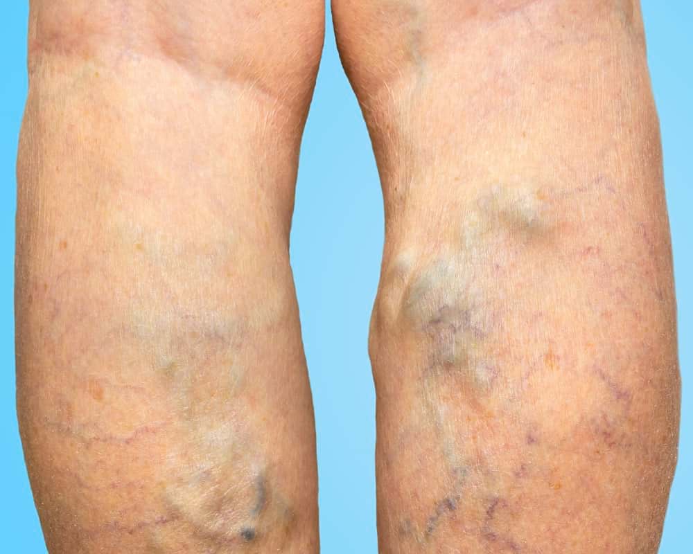 Varicose Veins Treatments Hurt So Bad | Style Vanity
